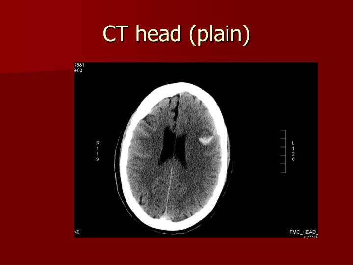 PPT - Headache and Subarachnoid Hemorrhage PowerPoint Presentation - ID ...