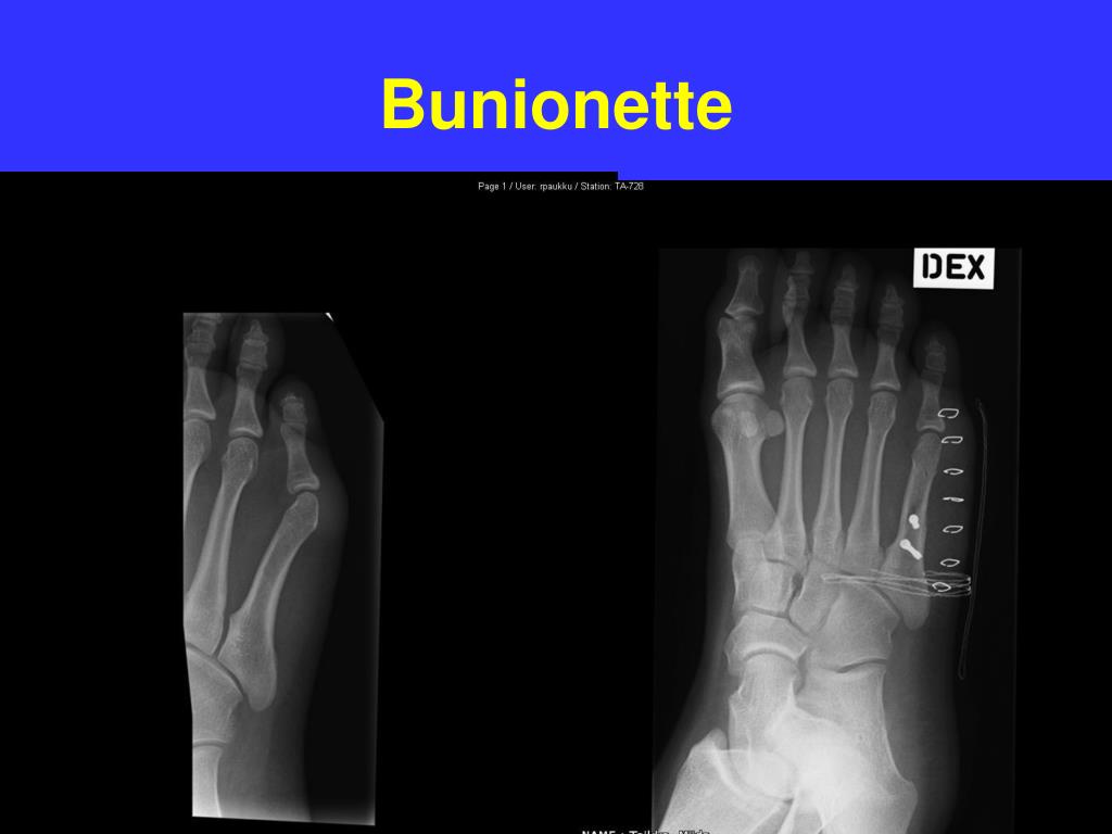 PPT - KASVUIKÄISEN TYYPILLISET RASITUSVAMMAT PowerPoint Presentation ...