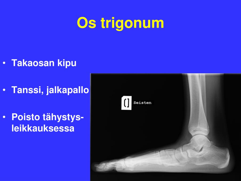PPT - KASVUIKÄISEN TYYPILLISET RASITUSVAMMAT PowerPoint Presentation ...