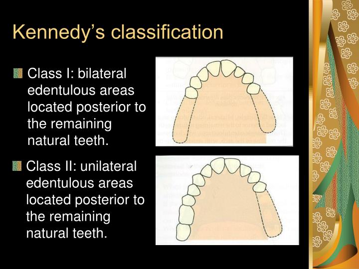PPT - INTRODUCTION & CLASSIFICATION OF RPD PowerPoint Presentation - ID ...