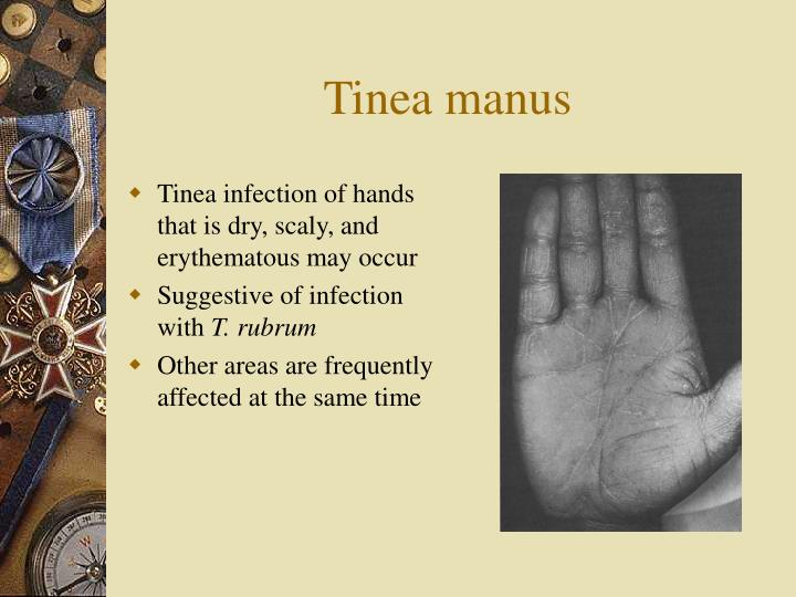 PPT - Chapter 15 Diseases Resulting from Fungi and Yeasts PowerPoint ...