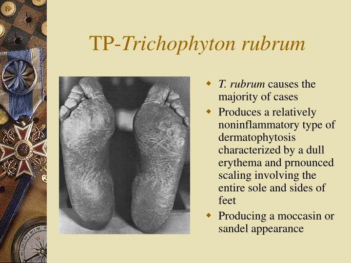 PPT - Chapter 15 Diseases Resulting from Fungi and Yeasts PowerPoint ...