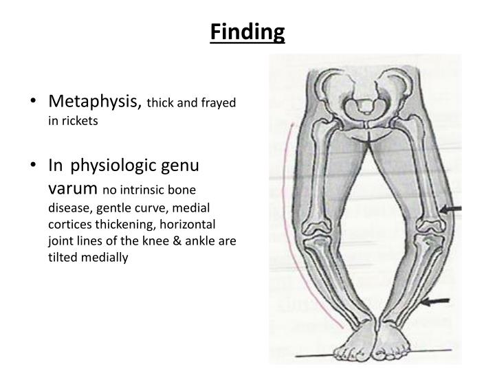 PPT - Genu valgus & Genu Varus PowerPoint Presentation - ID:550435