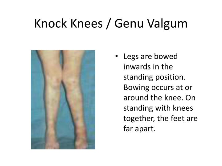 PPT - Genu valgus & Genu Varus PowerPoint Presentation - ID:550435