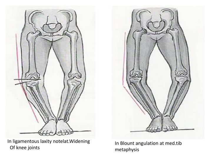 PPT - Genu valgus & Genu Varus PowerPoint Presentation - ID:550435