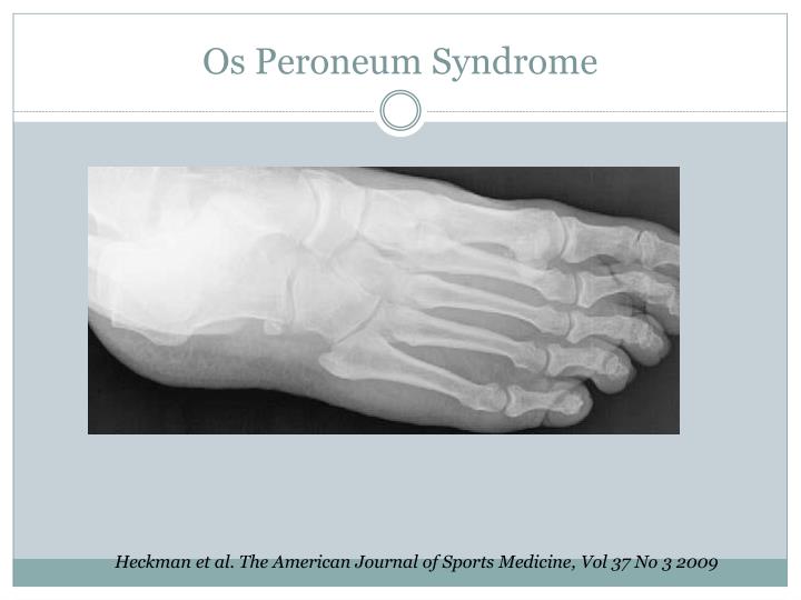PPT - Peroneal Tendon P athology PowerPoint Presentation - ID:551828
