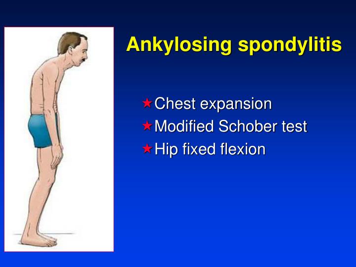 How To Measure Chest Expansion In Ankylosing Spondylitis at Amelia ...
