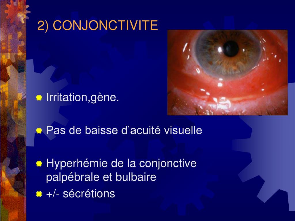 PPT - L’ŒIL ROUGE ET IRRITE DU SUJET AGE PowerPoint Presentation, free ...