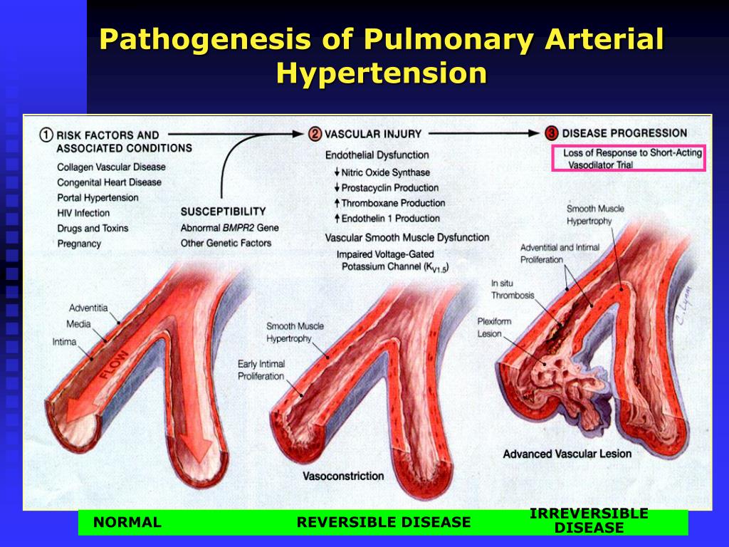 Ppt Pulmonary Hypertension Powerpoint Presentation Free Download