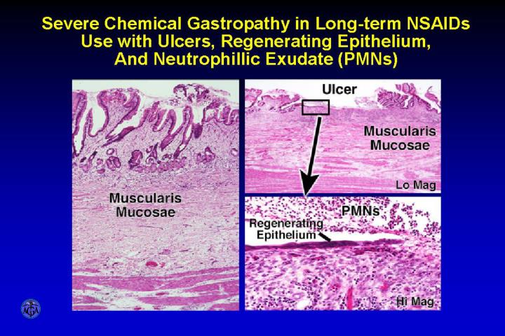 PPT - Hemorrhagic and Erosive Gastropathy - Endoscopy and Histology ...
