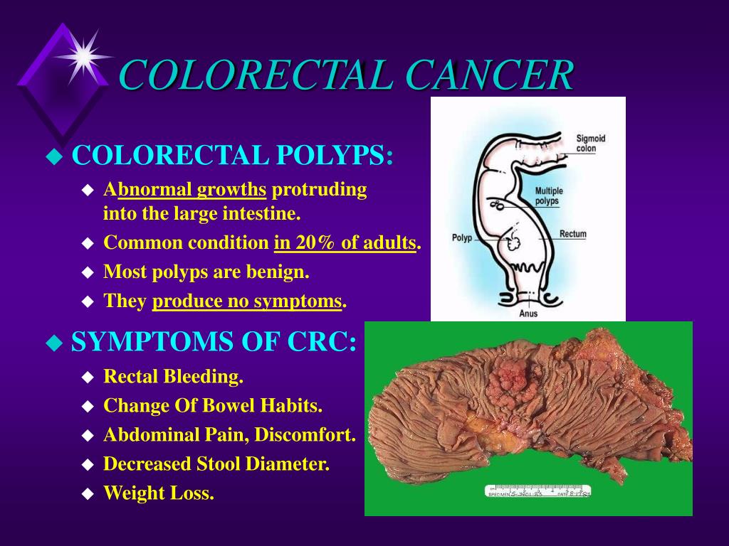 Ppt Colorectal Cancer Powerpoint Presentation Free Download Id 563571
