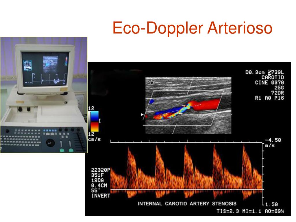 PPT - SEMEIOTICA DEI POLSI ARTERIOSI Il polso e il paziente con ...