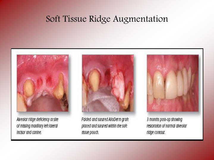 PPT - FAILURES IN PERIODONTAL THERAPY PowerPoint Presentation - ID:579262