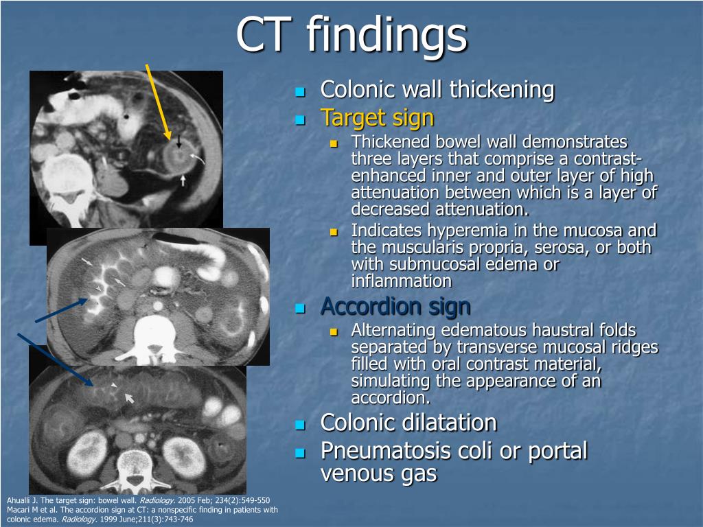 PPT - Review of Inflammatory Bowel Disease PowerPoint Presentation ...