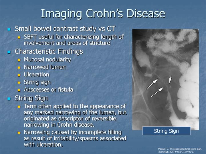 PPT - Review of Inflammatory Bowel Disease PowerPoint Presentation - ID ...