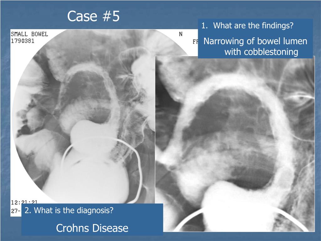 PPT - Review of Inflammatory Bowel Disease PowerPoint Presentation ...