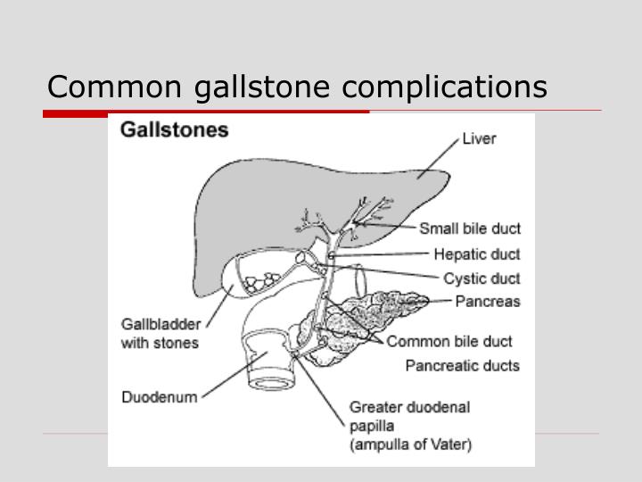PPT - Mirizzi Syndrome An Uncommon Gallstone Complication PowerPoint Presentation - ID:585573