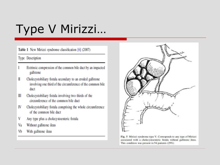 PPT - Mirizzi Syndrome An Uncommon Gallstone Complication PowerPoint ...