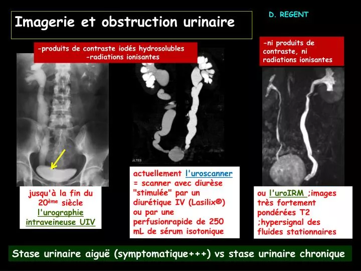 Uroscanner et 3 L'uroscanner a montré un léger rehaussement pariétal ...
