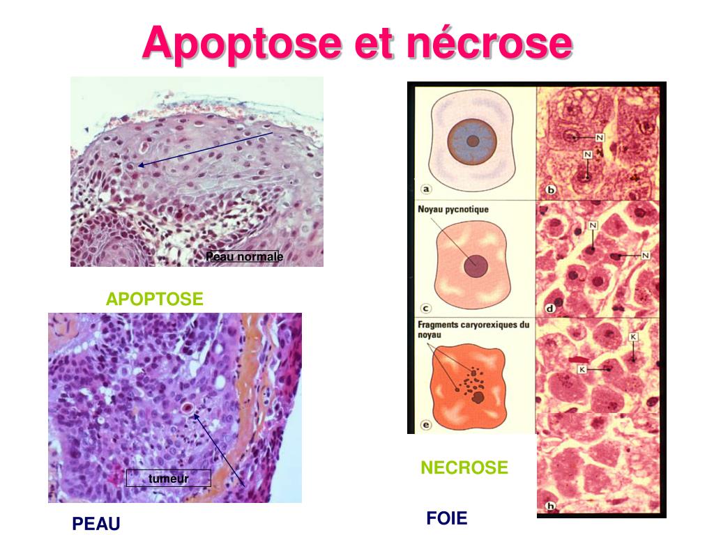 PPT - LESIONS ELEMENTAIRES DES TISSUS ET DES ORGANES PowerPoint ...