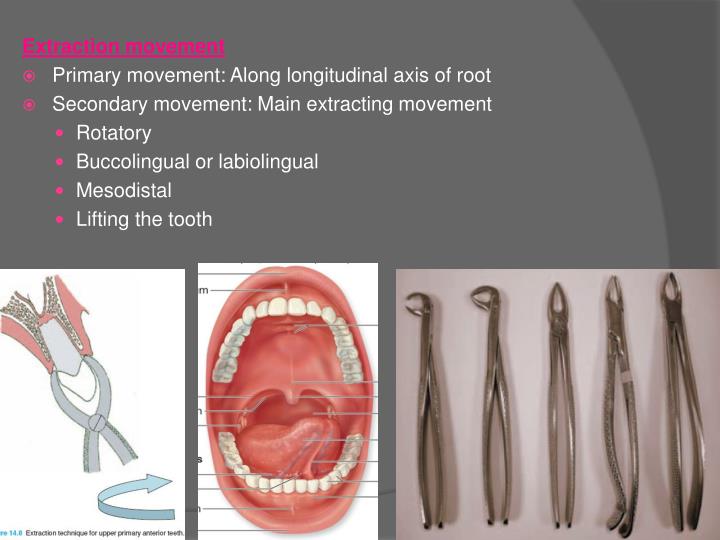 PPT - TOOTH EXTRACTION PowerPoint Presentation - ID:590214