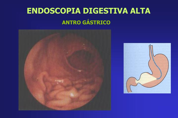 PPT - ENDOSCOPIA ALTA DIAGNÓSTICA: INDICACIONES Y COMPLICACIONES ...
