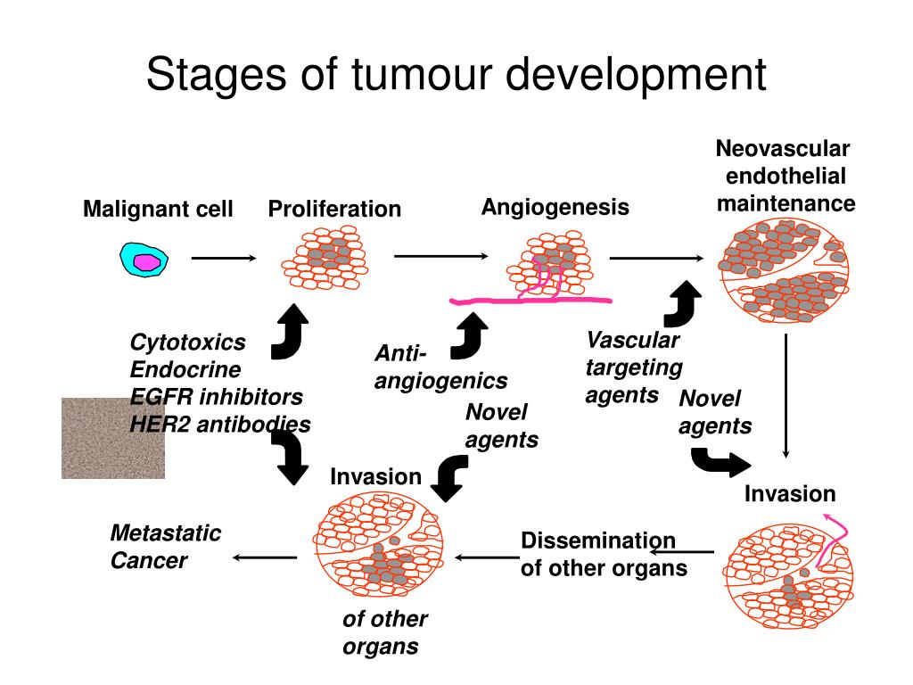 Stages Of Tumor Development And Mechanism Of Metastasis Stages Of Tumor Development And Mechanism Of Metastasis