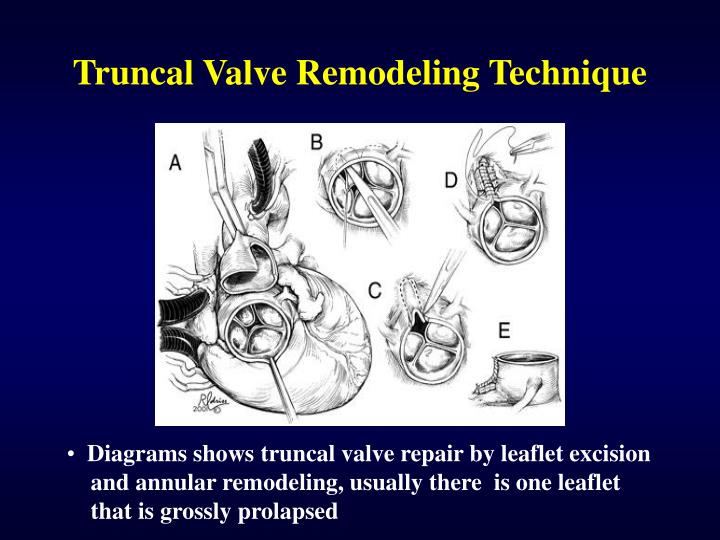 PPT - Truncus Arteriosus PowerPoint Presentation - ID:597141