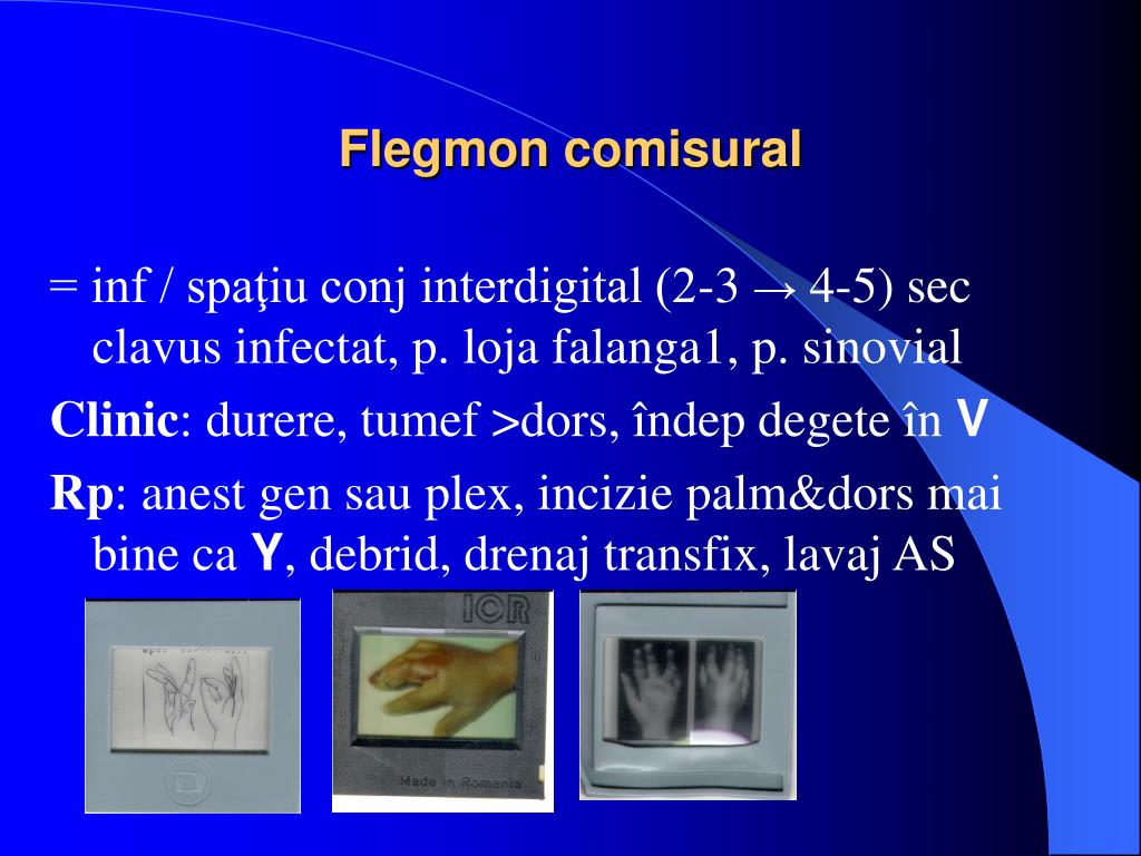 PPT - Infecţii acute ale mâinii şi degetelor PowerPoint Presentation ...