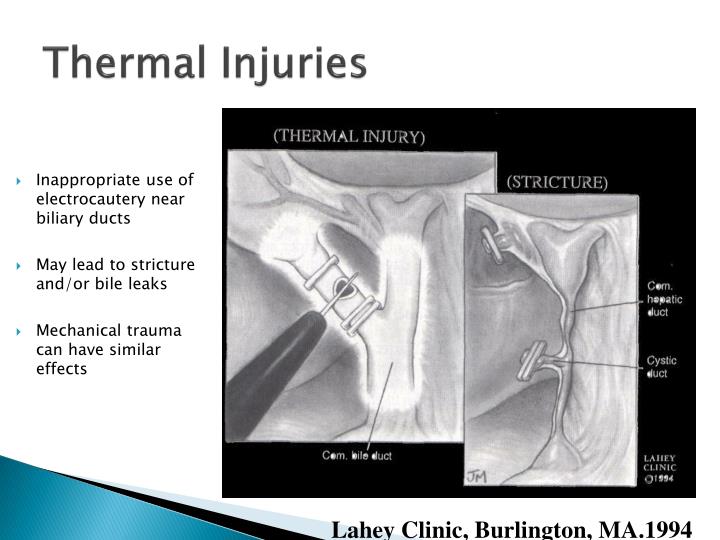 PPT - Biliary Injuries During Laparoscopic Cholecystectomy PowerPoint ...