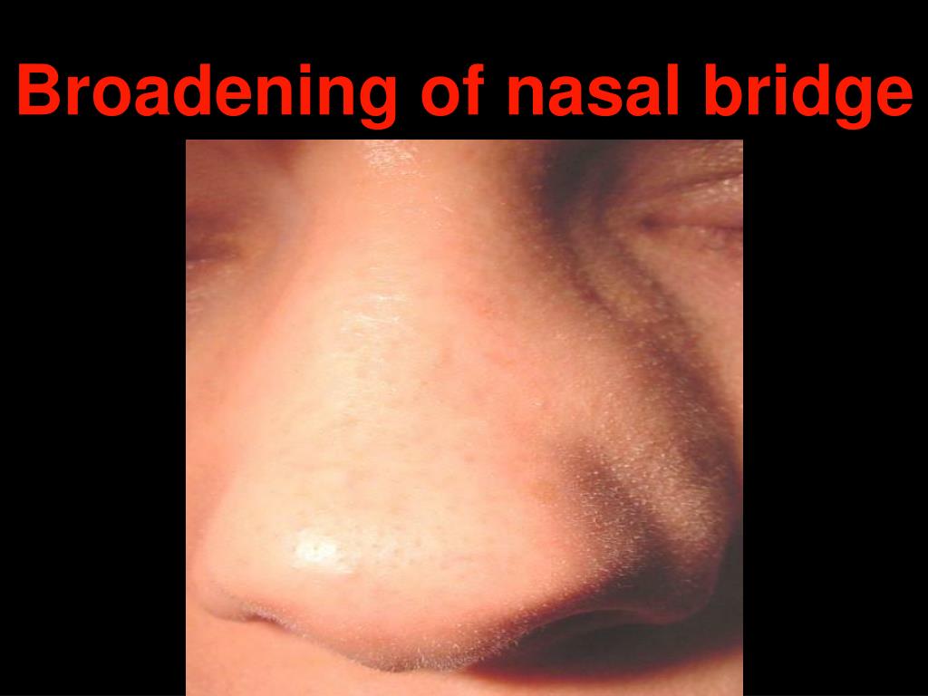 Ppt Nasal Polyps Powerpoint Presentation Free Download Id 602549