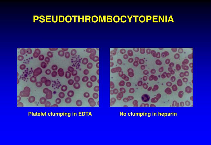 PPT - THROMBOCYTOPENIA PowerPoint Presentation - ID:608609