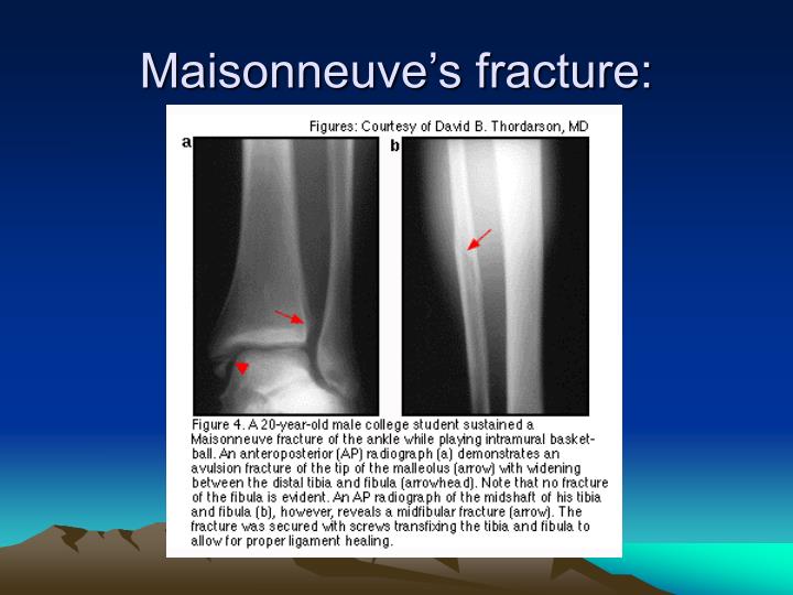 PPT - Foot and Ankle Fractures PowerPoint Presentation - ID:611999