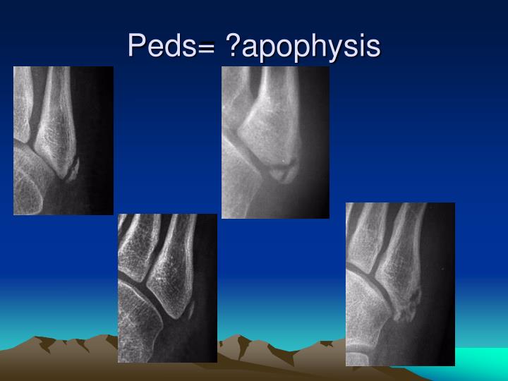 PPT - Foot and Ankle Fractures PowerPoint Presentation - ID:611999