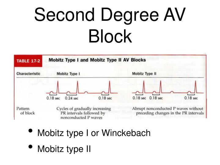 PPT - Atrioventricular (AV) Heart Block PowerPoint Presentation - ID:613537
