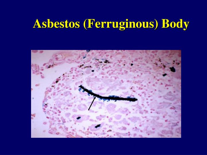 PPT - Occupational Lung Disease Jonathan Kass PowerPoint Presentation ...