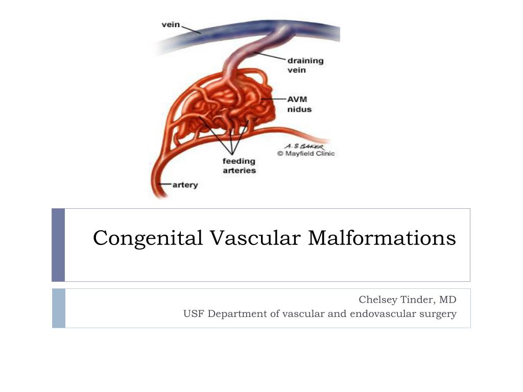 Ppt Congenital Vascular Malformations Powerpoint Presentation Free