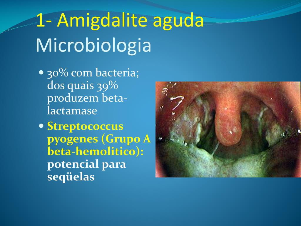 PPT - ENFERMIDADES DE AMÍGDALAS E ADENÓIDES PowerPoint Presentation ...