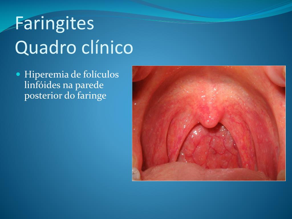 PPT - ENFERMIDADES DE AMÍGDALAS E ADENÓIDES PowerPoint Presentation ...