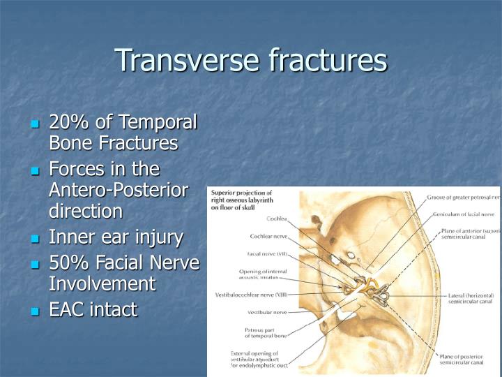 PPT - Fracture of temporal bone PowerPoint Presentation - ID:619231