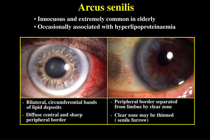 PPT - CORNEAL DEGENERATIONS PowerPoint Presentation - ID:619751