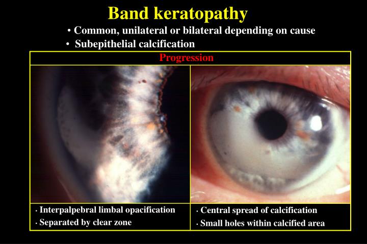 PPT - CORNEAL DEGENERATIONS PowerPoint Presentation - ID:619751