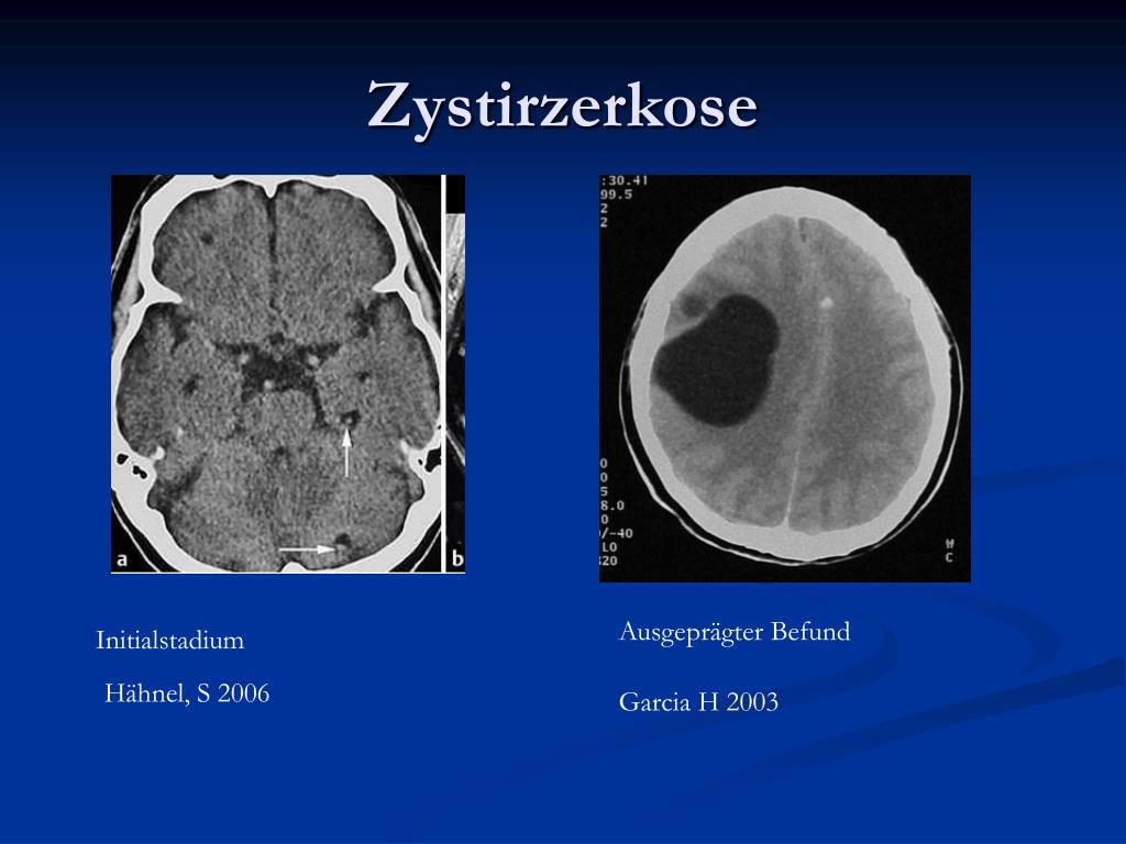 PPT - Enzündliche und Degenerative ZNS Erkrankungen im CT PowerPoint ...