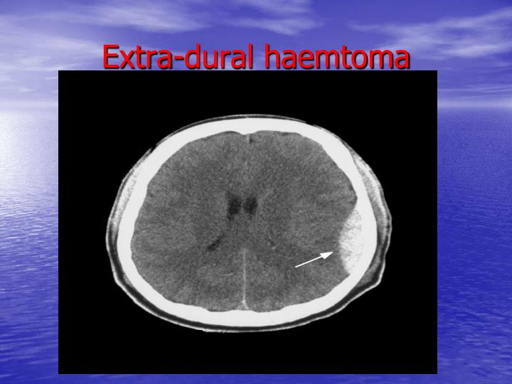 PPT - Subarachnoid Haemorrhage PowerPoint Presentation - ID:624626