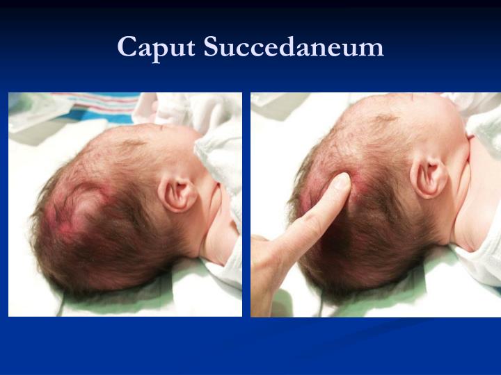 PPT - Common Newborn Findings PowerPoint Presentation - ID:625692