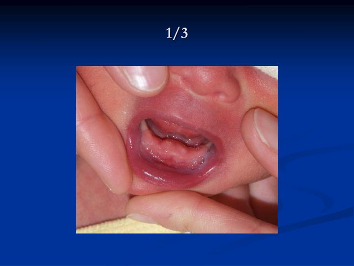 PPT - Common Newborn Findings PowerPoint Presentation - ID:625692