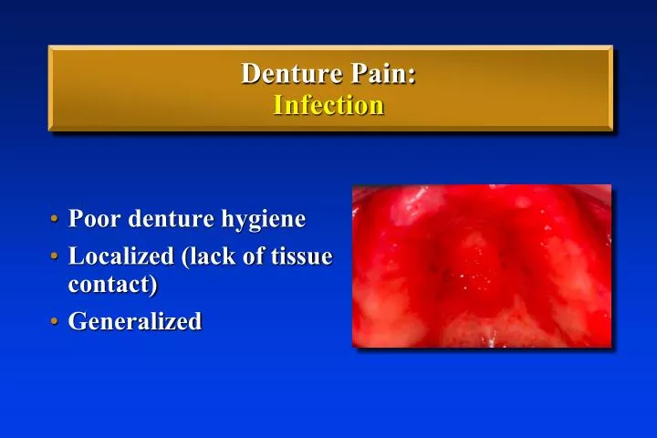 PPT - Denture Pain: Infection PowerPoint Presentation, free download ...