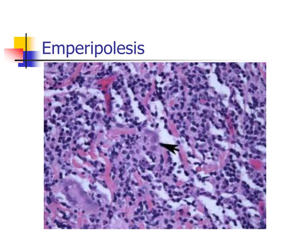 PPT - Sinus Histiocytosis with Massive Lymphoadenopathy (Rosai-Dorfman ...