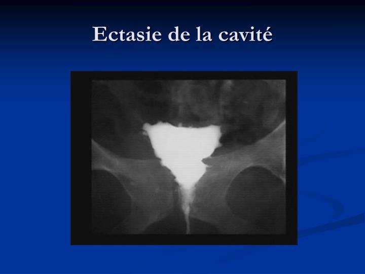 PPT - DIAGNOSTIC DE L’ADENOMYOSE PowerPoint Presentation - ID:631340