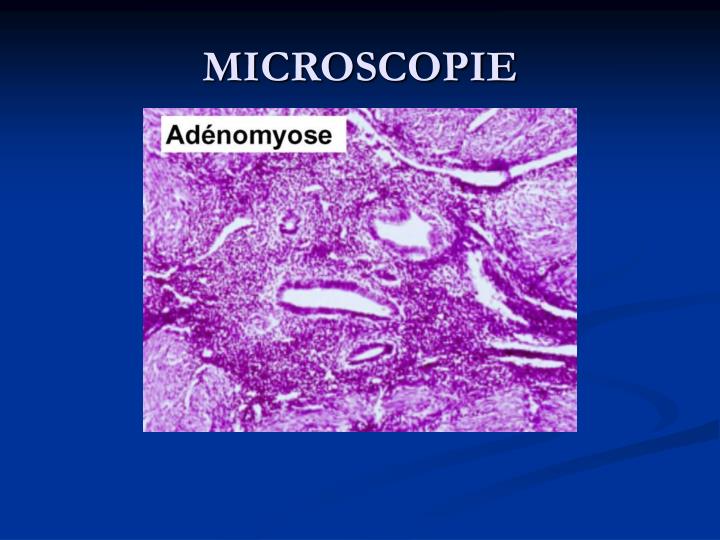PPT - DIAGNOSTIC DE L’ADENOMYOSE PowerPoint Presentation - ID:631340